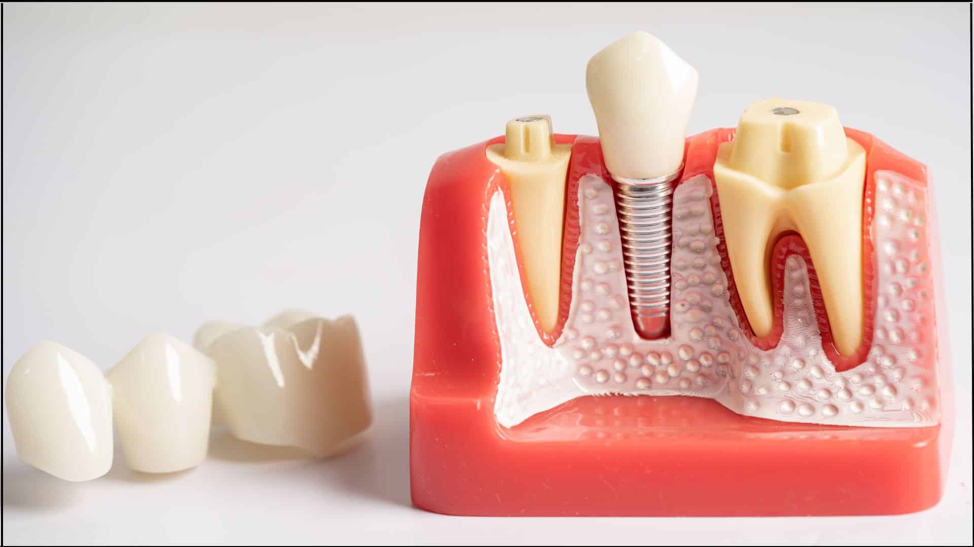 Missing Teeth? Get Smile Back: Dental Implants Missing Teeth? Get Smile Back: Dental Implants